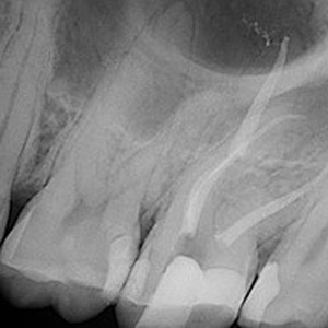 Non-surgical Cases by Dr. Abtin – Northshore Endodontic Centre