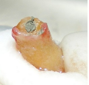 Surgical Cases by Dr. Abtin – Northshore Endodontic Centre