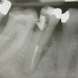 Non-surgical Cases by Dr. Abtin – Northshore Endodontic Centre