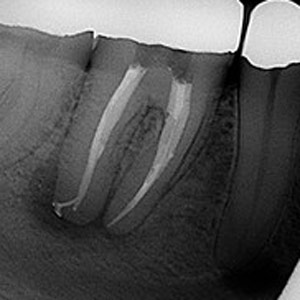 Non-surgical Cases by Dr. Abtin – Northshore Endodontic Centre