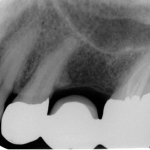 Non-surgical Cases by Dr. Abtin – Northshore Endodontic Centre